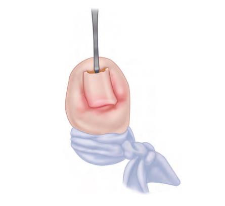 Ingrown Toenail Surgery | CurveCorrect